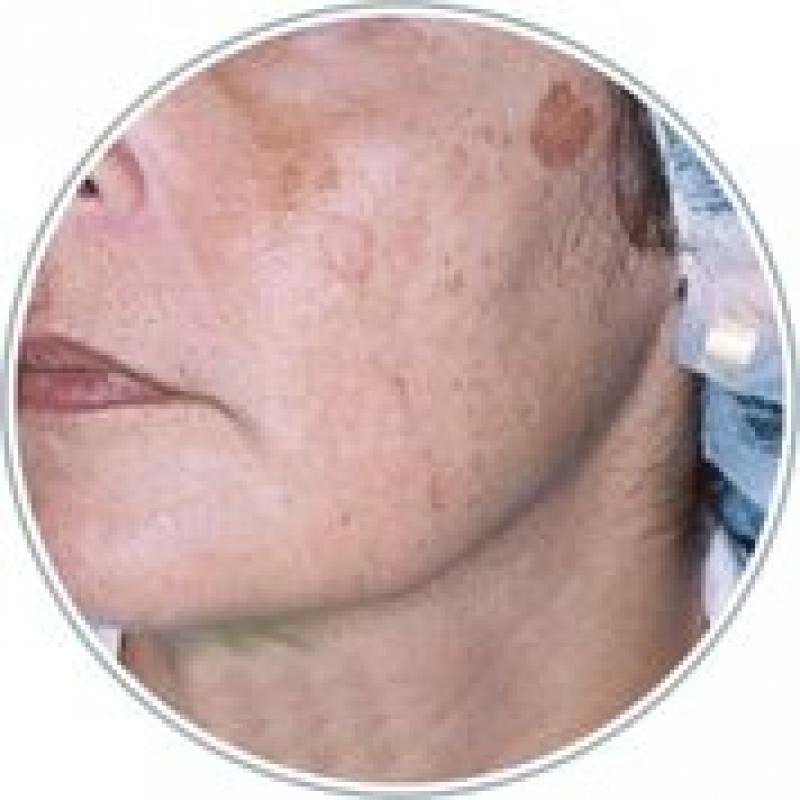 Cosmelan-Depigmentation Treatment - The Guerrera Clinic